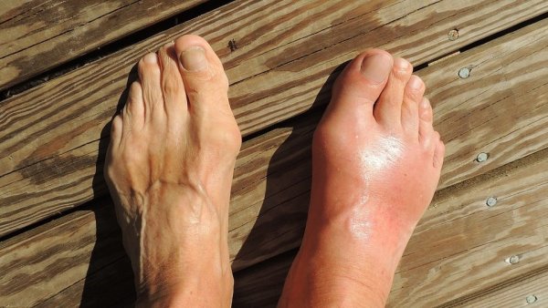 Five Minute Guide To Control Gout Spot the symptoms. Gout often appears ...